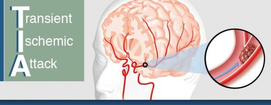 Understanding Transient Ischemic Attacks (TIA): Symptoms, Causes, and ...